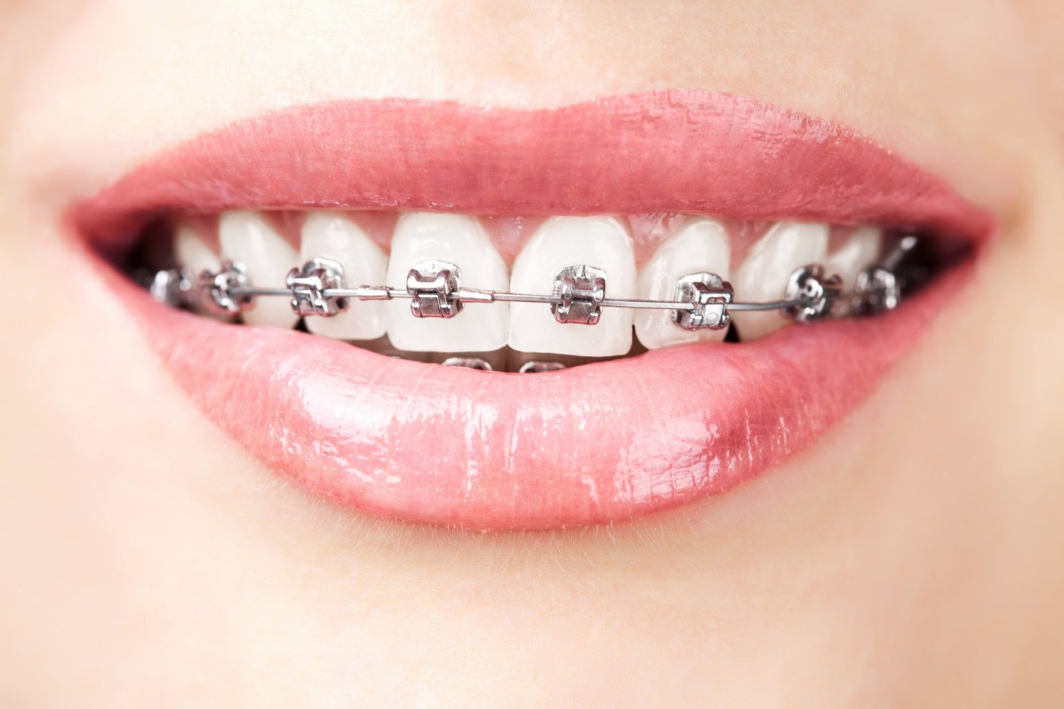 What’s the Difference Between Traditional & Self-Ligating Braces ...